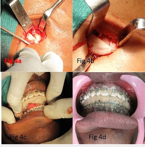 A Overlapping Segments B Overlapping Segments C Mandibular