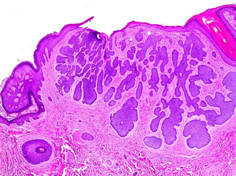 Pathology Outlines Basal Cell Carcinoma Vulva