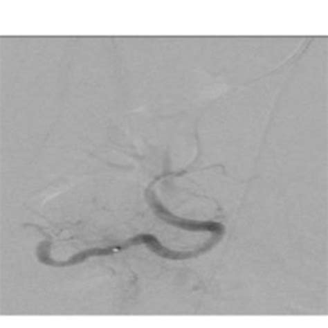 Coiled Embolization Of Her Gastroduodenal Artery Via Her Superior