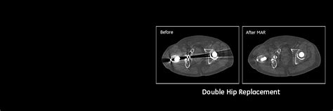 Metal Artifact Reduction Radiation Therapy Planning Computed Tomography Categories Ge