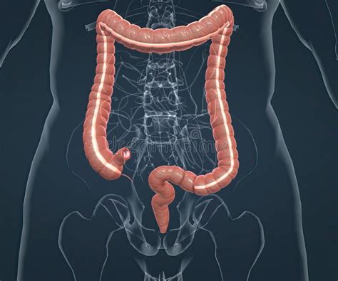Appendicitis Is A Painful Swelling Of The Appendix Stock Illustration