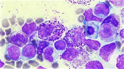 Aml With Inv 16