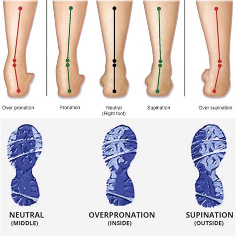 What Is Supination Of The Foot At Lola Michell Blog