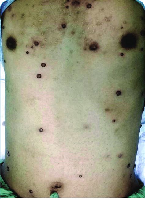 A Multiple Skin Nodules Present Over The Trunk Download Scientific Diagram