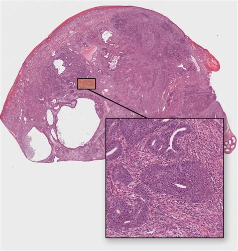 Cornell Study Reveals Why Testicular Cancer I Eurekalert