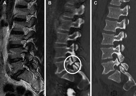 Zero Echo Time Musculoskeletal Mri Technique Optimization