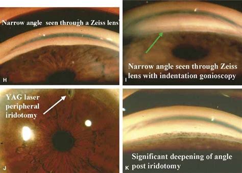 Doczone Interesting Ophthalmology Clinical Photographs Eye Facts Eye Health Eye Anatomy