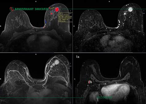Бриллиант 📌Хөхний соронзон резонанст томографи Breast Mri нь Хөхний хортой болон хоргүй