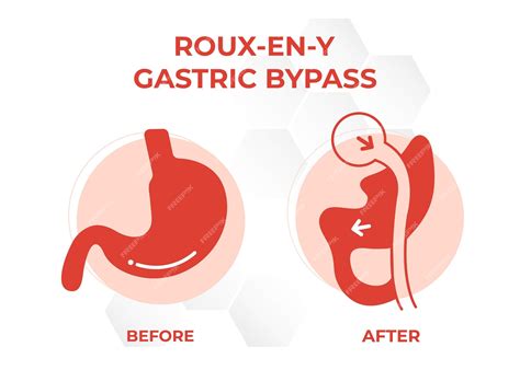 Premium Vector Gastric Bypass Rny Weight Loss Surgery Vector Premium Vector Gastric Bypass Rny Weight Loss Surgery Vector