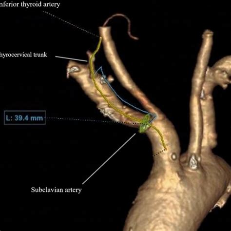 Distance Between The Right Thyrocervical Trunk And The Origin Of The Download Scientific