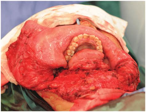 Intra Operative Photograph Of The Patient After Segmental Download Scientific Diagram