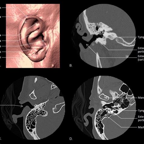 Pdf Ct Imaging Of The Temporal Bone Tb Making Easy What Used To Be
