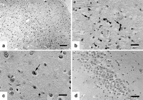 microscopic findings of patient iii 4 a he staining of frontal