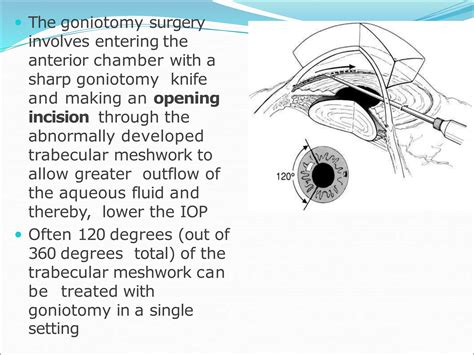 Primary Congenital Glaucomappt