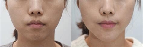 톡스앤필 청주점 팔자무턱필러자갈턱보톡스 네이버 블로그