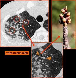 Chest CT Tree In Bud Sign