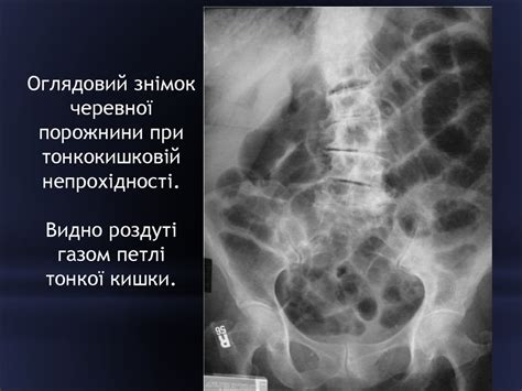 Променева діагностика захворювань шлунково кишкового тракту презентация онлайн