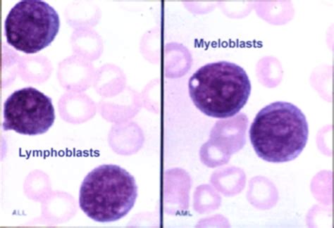 Lymphoblast