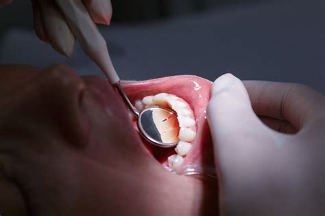 How To Fix Receding Gums Without Surgery