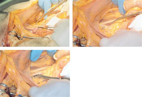 Radical Hysterectomy Clinical Tree