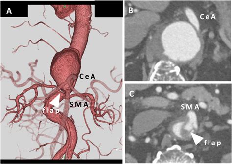 Contrast Enhanced Ct Scan A 3 Dimension Ct Angiography There