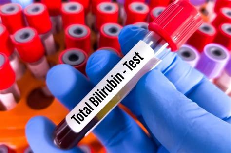 Total Billirubin Shiridi Sai Seva Trust