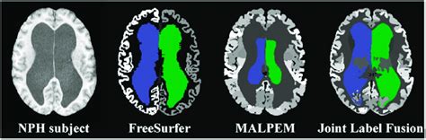 an example of a failed segmentation on a subject with severe