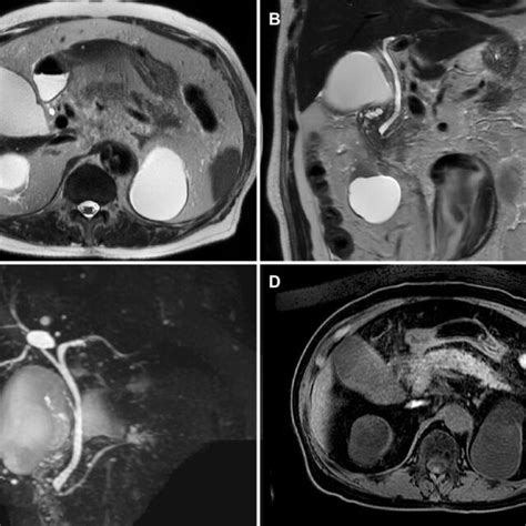 Magnetic Resonance Cholangiopancreatography Shows No Radiolucent Download Scientific Diagram