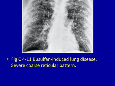 4 Diffuse Reticular Or Reticulonodular Pattern Pptx