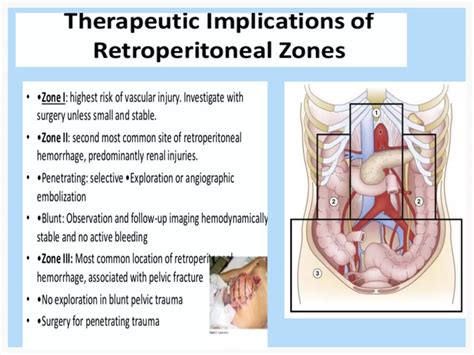 Retroperitoneal Mass Pptx