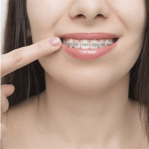 Braces Color Rubber Bands