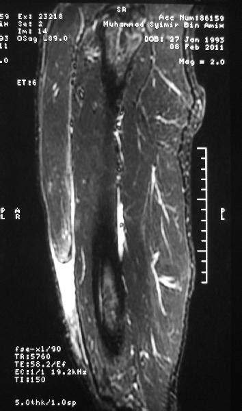 A Rare Form Of Soccer Injury Rectus Femoris Tendon Rupture HC Chang