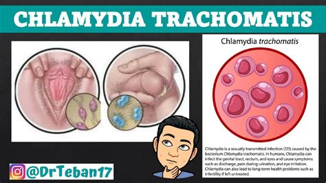 Chlamydia Trachomatis Drteban17 Udocz