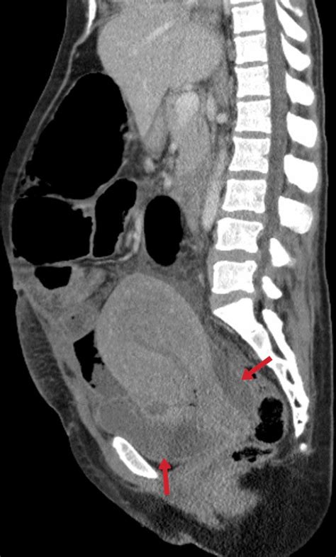 Acute Pyogenic Pelvic Inflammatory Disease As A Late Sequelae Of