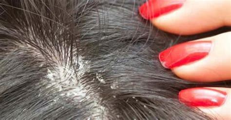 Hot Sun Raises The Risk Of Scalp Fungus