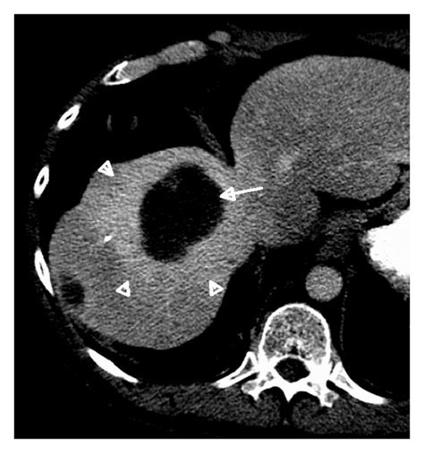 56 Year Old Male Patient With Cholangiocarcinoma Axial Ct At Delayed
