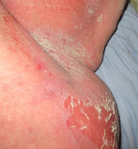 Pseudo Nikolsky Par Confluence De Pustules Dans Une Pustulose