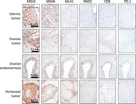 Elucidating The Pathogenesis Of Synchronous And Metachronous Tumors In