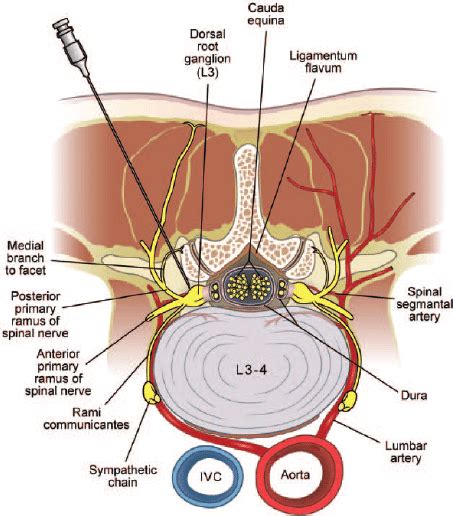 Axial View Of Lumbar Transforaminal And Selective Nerve Root Injection