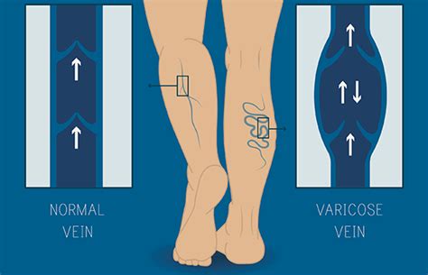 Understanding Vein Disease And Aesthetic Vein Problems Harley Street London