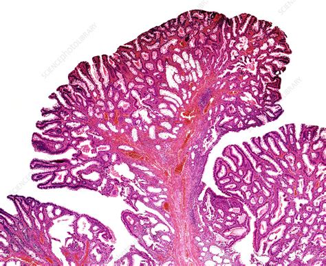 Hereditary Mixed Polyposis Syndrome Light Micrograph Stock Image