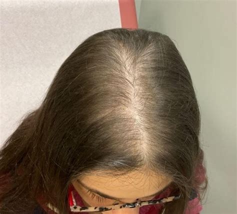Thyroid Hair Loss How To Spot Its Signs And Reverse It