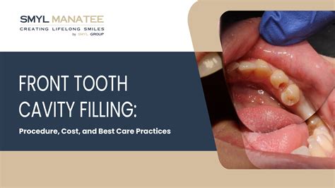 Front Tooth Cavity Filling Procedure Cost And Best Care Practices