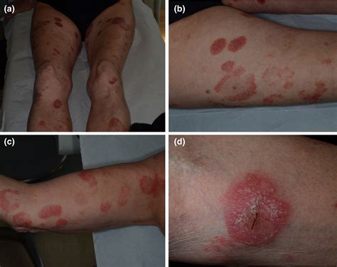 De Novo Annular Pustular Psoriasis Following Mrna Covid‐19 Vaccine