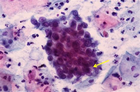 Issues Of The Evaluation Of Endocervical Cells Of The Uterine Cervix On