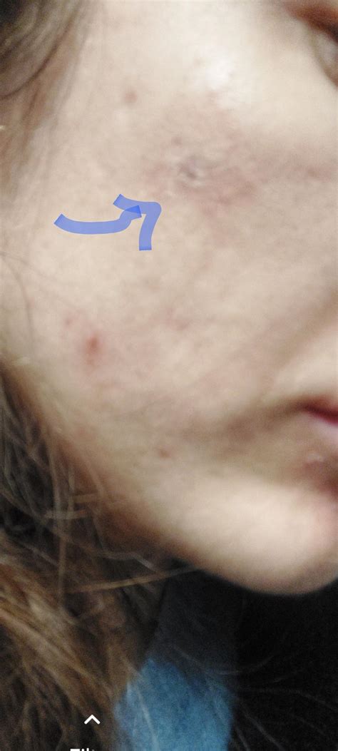 Deep Nodular Pimple What Do You Suggest Racnetreatments