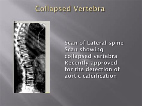 Ppt Bone Density And The Dxa Scanner Powerpoint Presentation Free