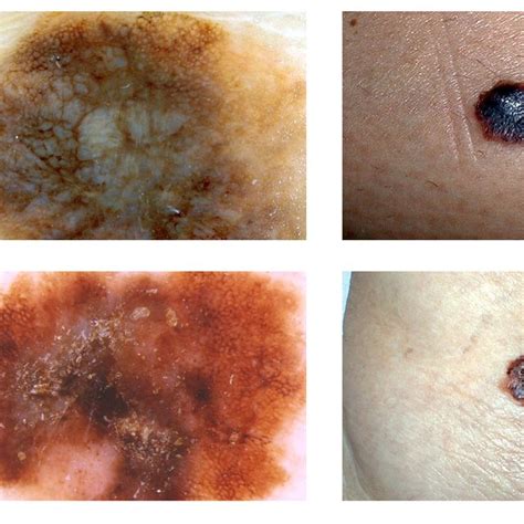 Pdf 7 Point Checklist And Skin Lesion Classification Using Multi Task
