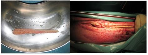 Reconstruction Of Bone Loss In An Open Fracture Of The Tibia With A Contralateral Free Tibial