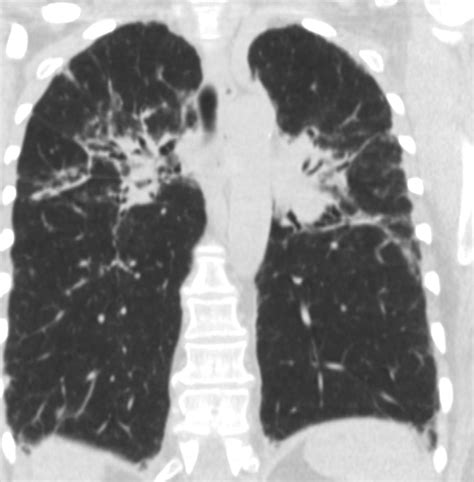 200 Lu Stage 4 Sarcoidosis The Common Vein